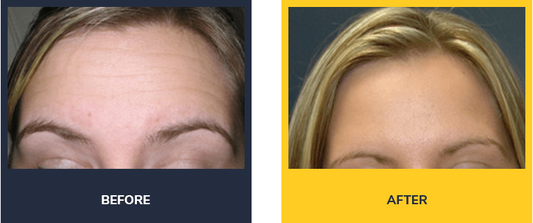 Botox Toronto | Younger Skin | Fairview Laser Clinic Inc.