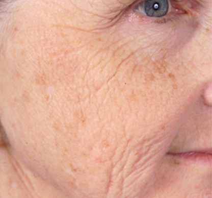 Age & Liver Spots Treatment Toronto | Fairview Laser Clinic Inc.