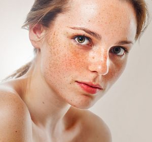 Birthmark Treatments Toronto | Fairview Laser Clinic