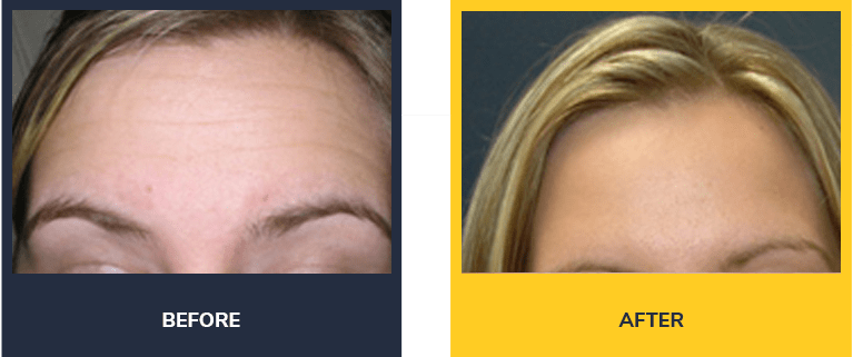 Facial Rejuvenation Toronto | Botox | Fairview Laser Clinic Inc.