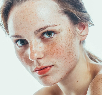 Non Laser Melasma Treatment Toronto | Fairview Laser Clinic Inc.