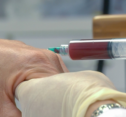 Platelet Rich Plasma Injections Toronto | Fairview Laser Clinic Inc.